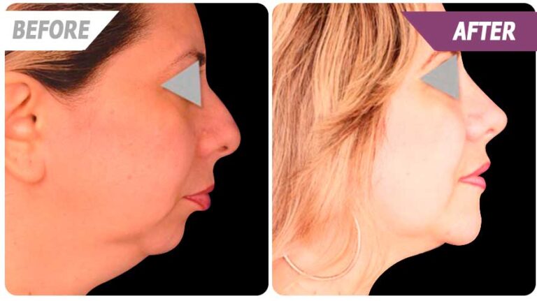 Mentoplasty / Chin surgery – Cirugía Plástica en Lima Perú, Dr. Pedro ...